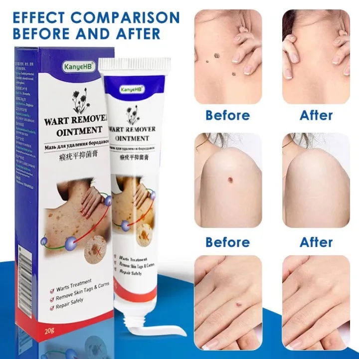 KANYEHB Warts Remover Ointment For Hand/Foot/Face And Whole Body Skin ...