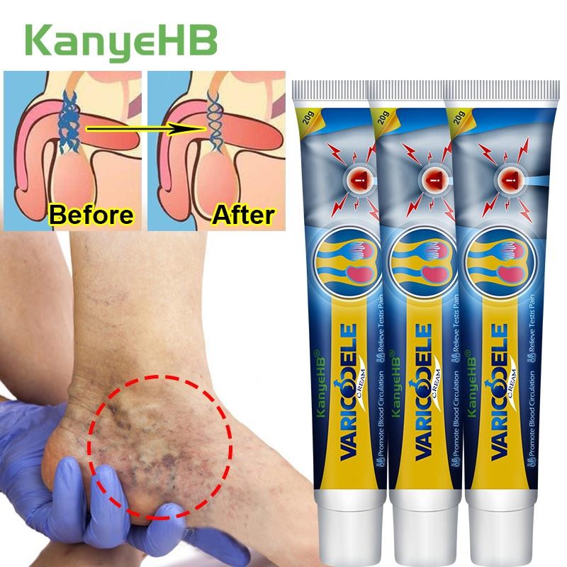 ️3Pcs Varicose Vein Treatment Cream Relieve Legs Dilated Vasculitis ...