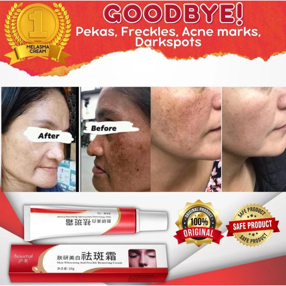 Buy 1 Take 1 Effective Melasma Cream Pekas Remover Skin Whitening ...