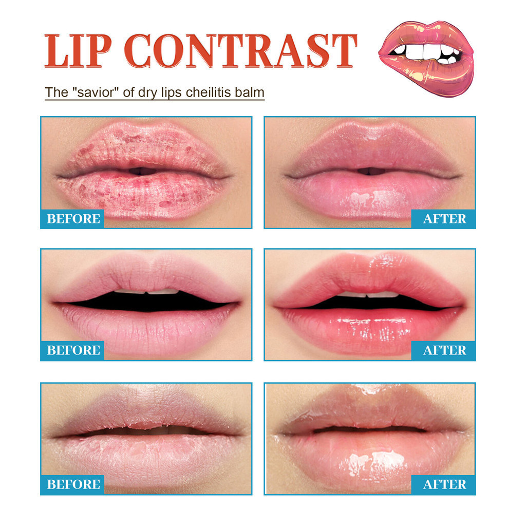 Ouhoe Cheilitis Treatment Cream Inflammation Labial Herpes Antibacterial Ointment Chapped Lips ...