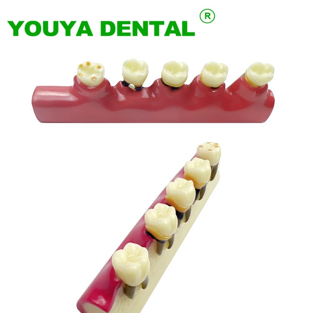 ⓥTeeth Periodontal Disease Model Dental Caries Breakdown Display ...