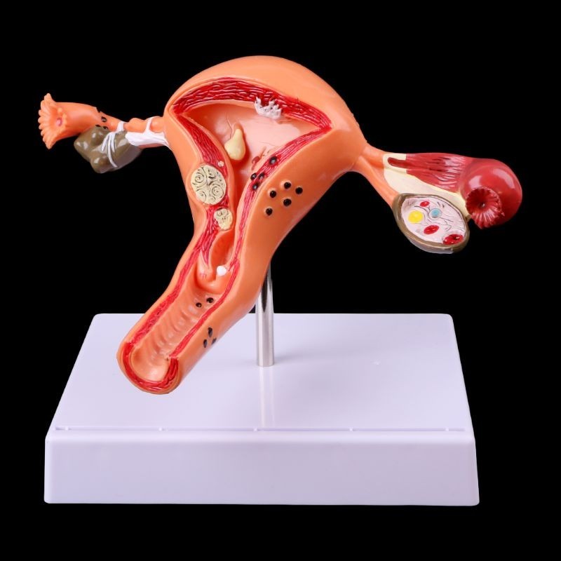 Medical props model Free postage Pathological Uterus Ovary Anatomical ...