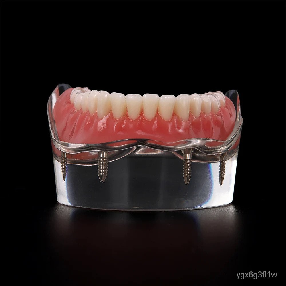 Dental Implant Restoration Teeth Model Removable Bridge Denture Demo ...