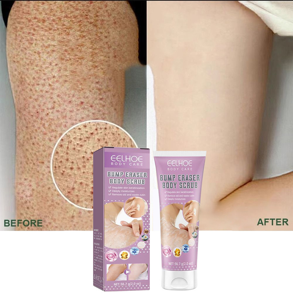 Keratosis Pilaris Cream For Strawberry Legs Removal KP Bump Eraser Dark ... Keratosis Pilaris Cream For Strawberry Legs Removal KP Bump Eraser Dark ...
