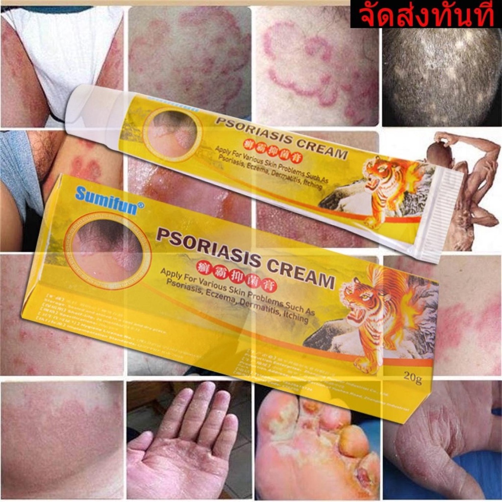Sumifun Psoriasis Ointment Skin Ointment Dermatitis Eczema Tinea