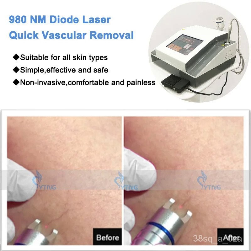 High Quality Spider Vein Treatment Machine with Skin Cooling 980nm ...