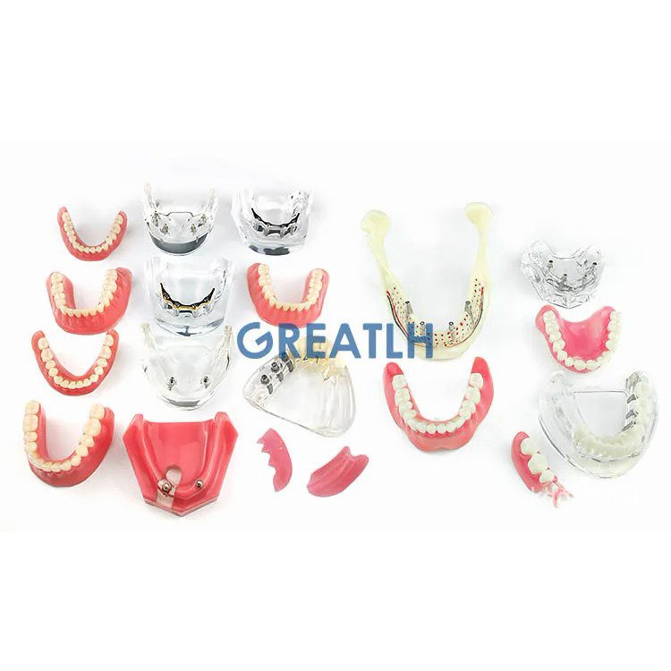 Dental Teeth Model With Implant Overdenture Inferior Demo Mandibular ...