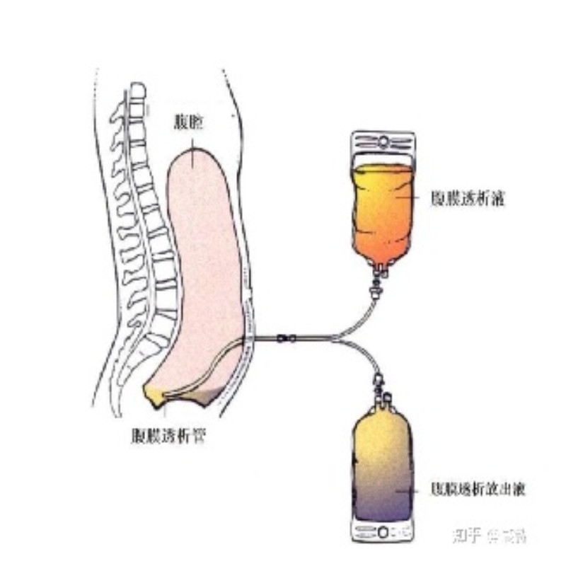 Full-automatic peritoneal dialysis machine peritoneal dialysis pipeline ...