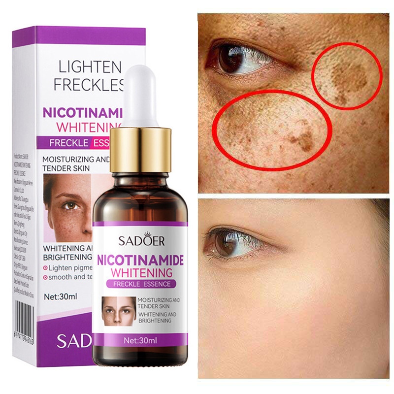 Freckles Cream Remove Melasma Dark Spot Anti-freckle Essential Essence ...