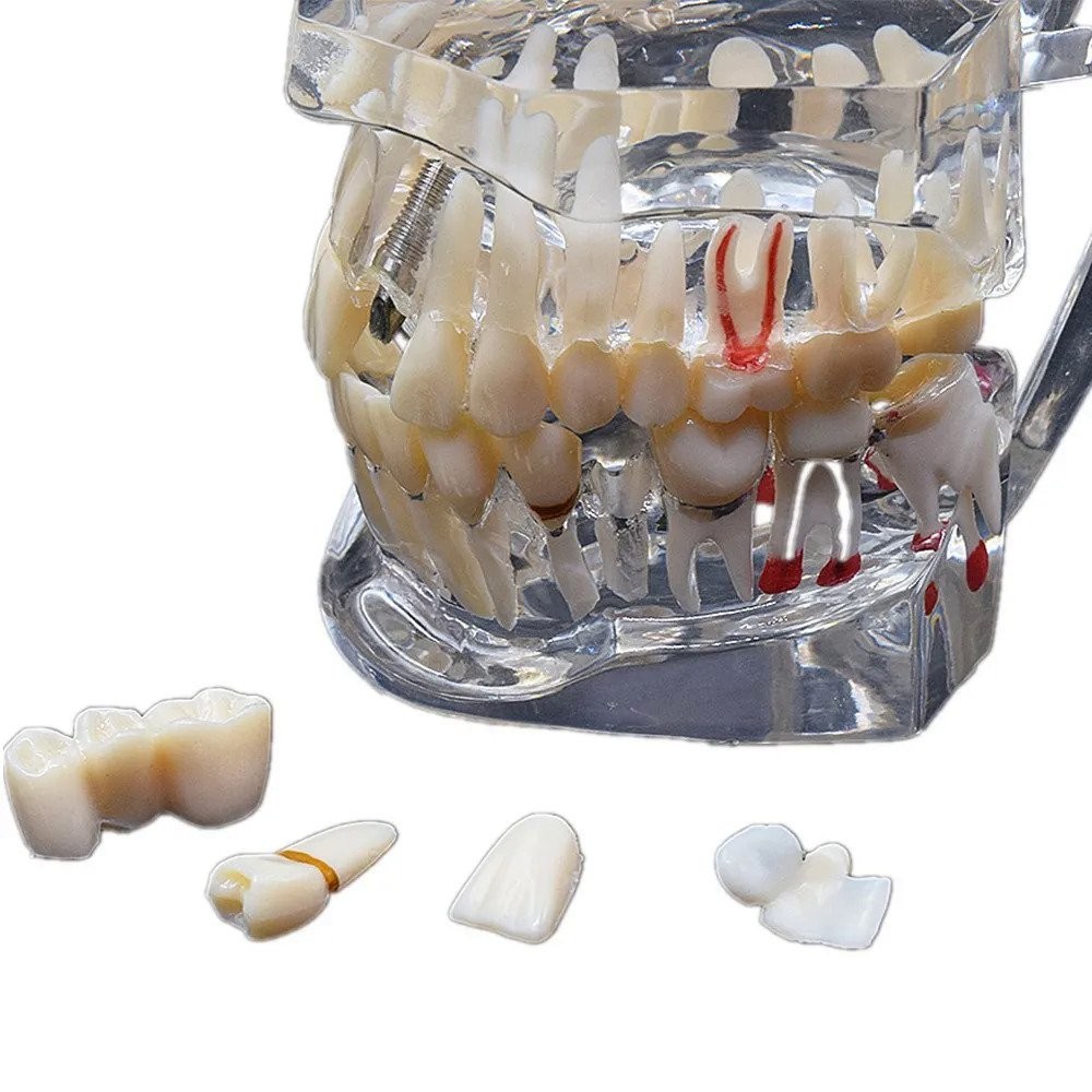 Dental Consumable Teeth Model Medical Studying Implant Disease With ...