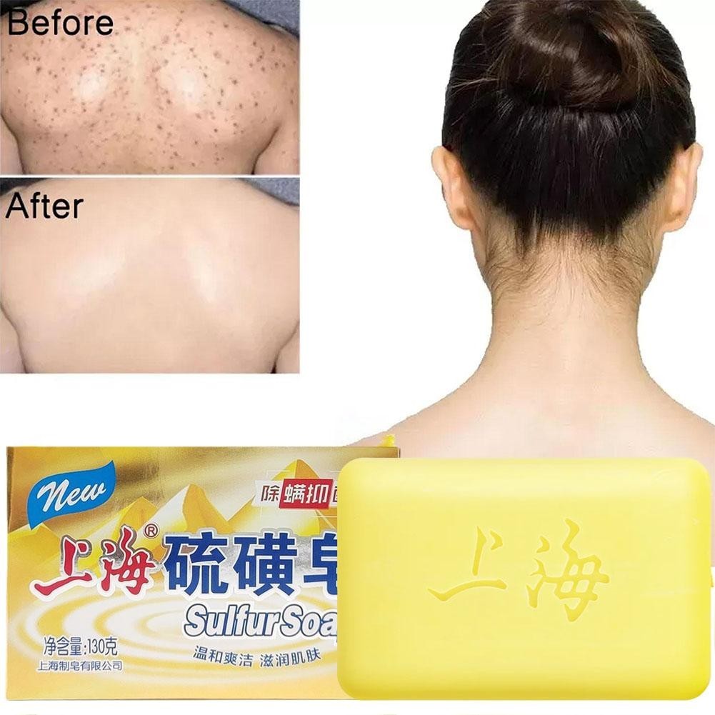 Shanghai Sulfur Soap Acne Psoriasis 4 Skin Conditions Fungus Anti ...