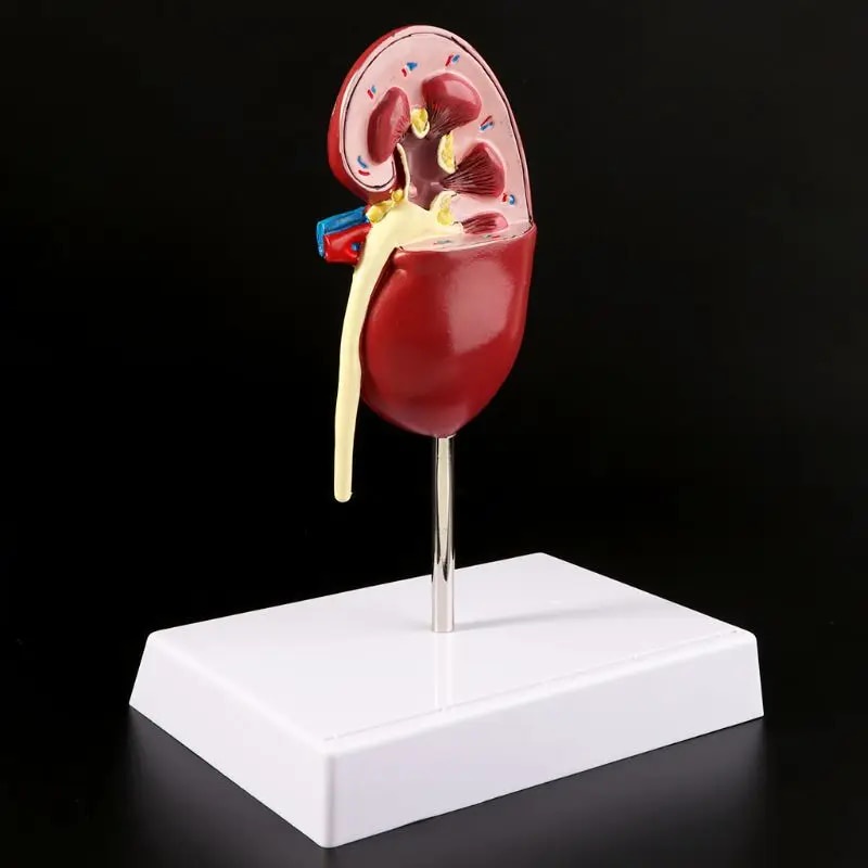 Medical props model Life Size Human Kidney Diseased Model Anatomical ...