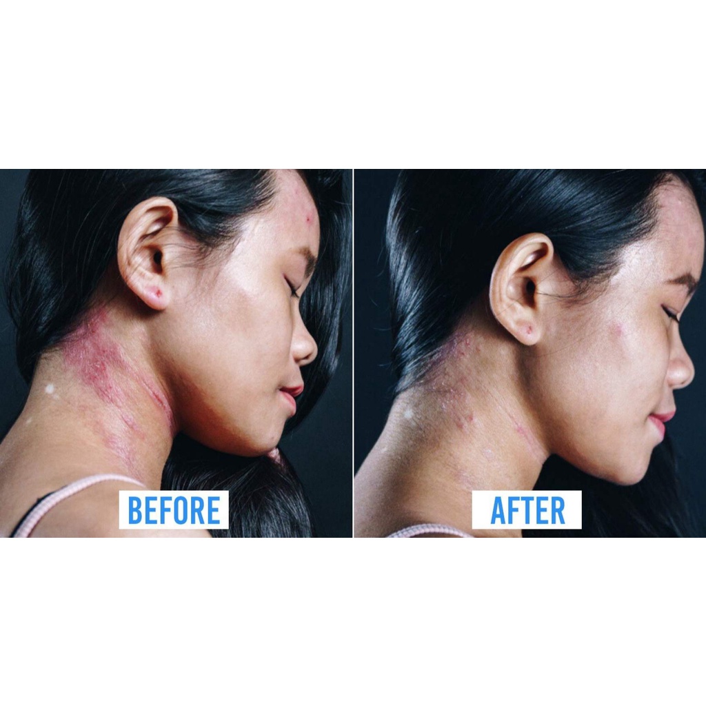 Lymarin Cream 15g / 5g (for Eczema, Dermatitis, Allergy, Rashes, Skin ...