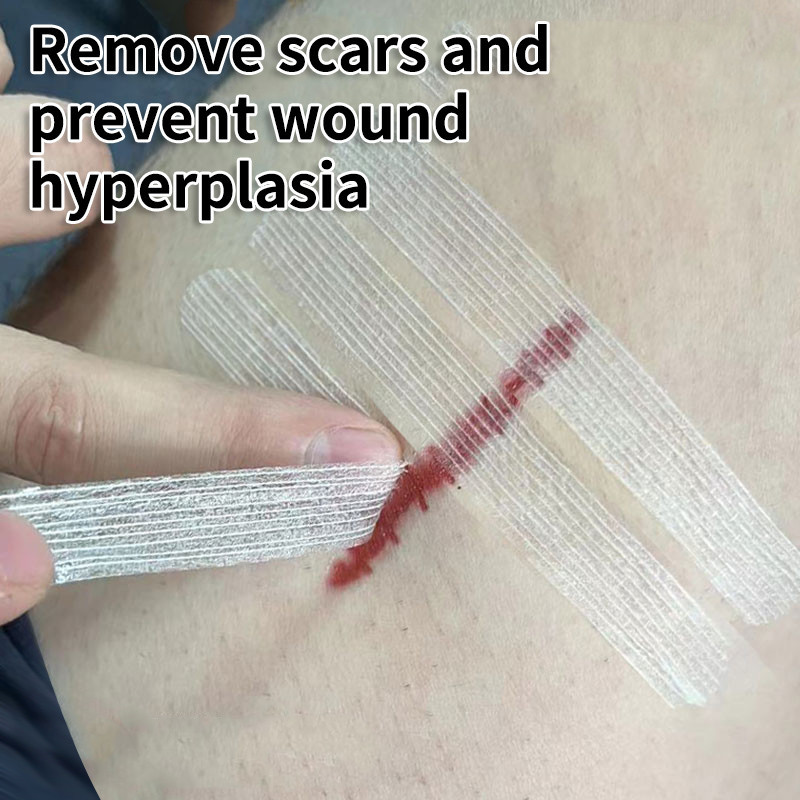 Steri Strip Wound Skin Closure Strips Surgical Sutures Postpartum Wound ...