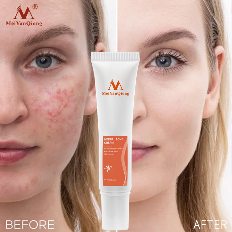 Acne Cream Acne Removal Eliminate Acne Marks Repair Damaged Skin ...