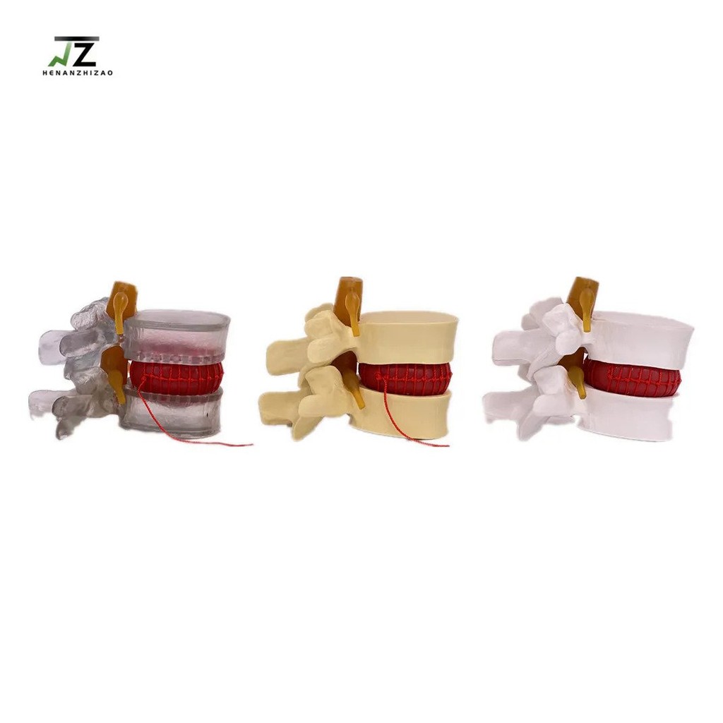 Lumbar Spine Model Intervertebral Disc Model Diseased Lumbar Spine ...