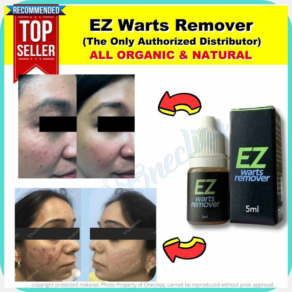 EZ~v:Warts_Rw%Remover`XU&for`YL&Moles`lw&|`FE&Skin`er&Tags,`QZ&Nunal ...