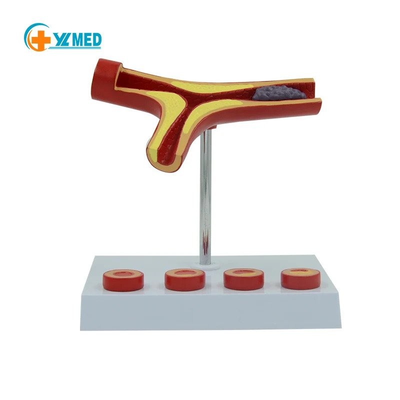 Medical Science Human Arterial Thrombosis and Sclerosis Teaching Model ...
