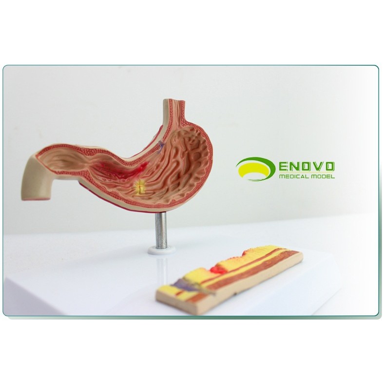 HFSA Systemic Pathological Gastric Ulcer Model Anatomical Model Model ...