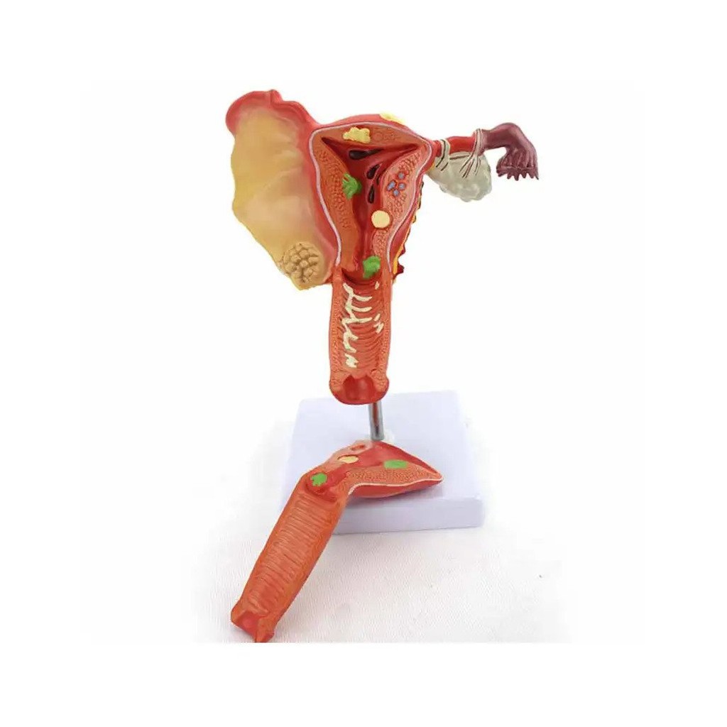 KyrenMed Pathological Model of the Female Genital Organs Human Uterus ...