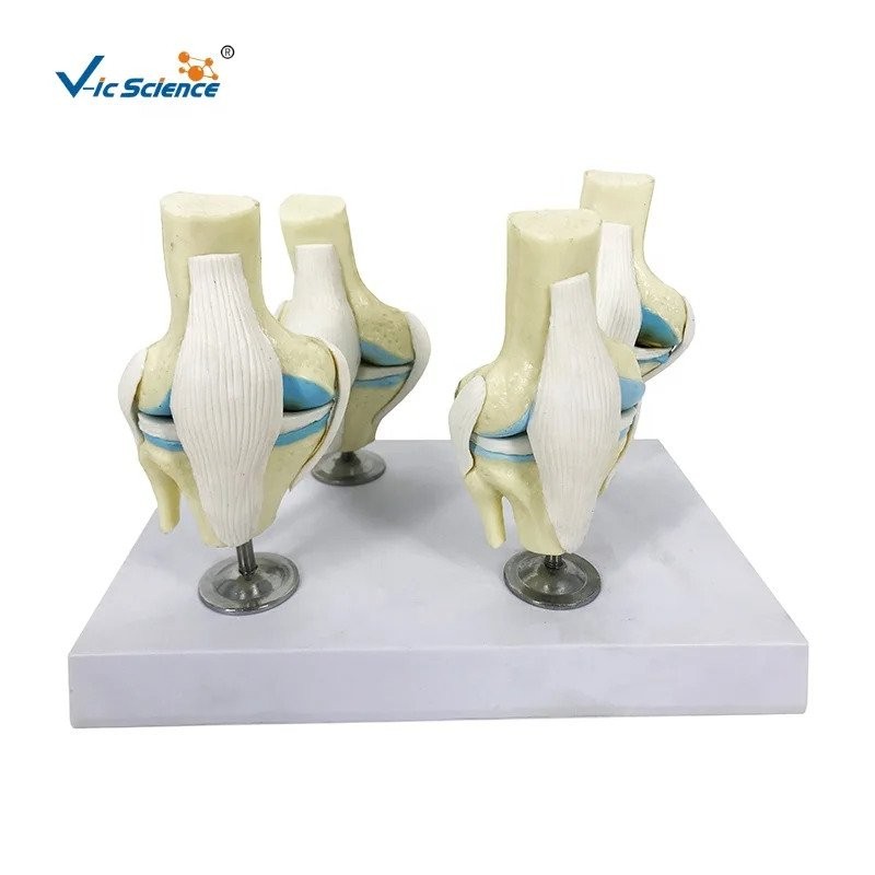 4 stage osteoarthritis knee set anatomy model anatomical model torso ...