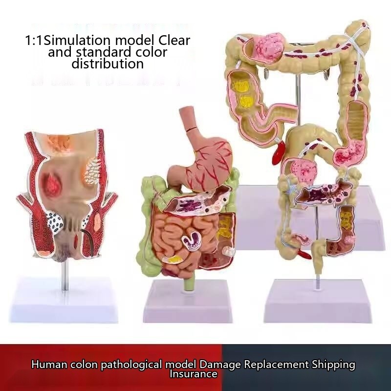 Colon Pathology Model Gastrointestinal Model Colon Lesion Model ...