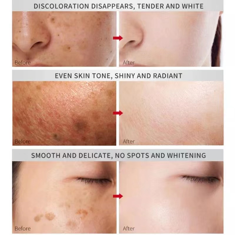 melasma cream pekas remover melasma cream peka remover collagen japan ...