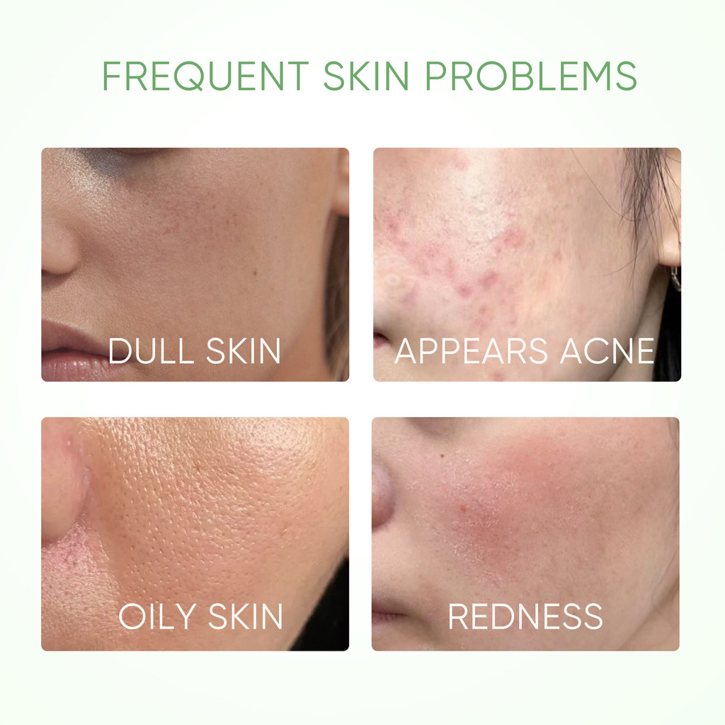 【Global】SKINTIFIC Acne Treatment Clay Mask 2PCS Acne Remover Mugwort ...