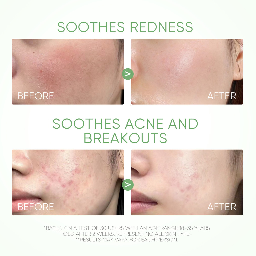 [GLOBAL] SKINTIFIC Acne Treatment Clay Mask 2PCS Acne Remover Mugwort ...