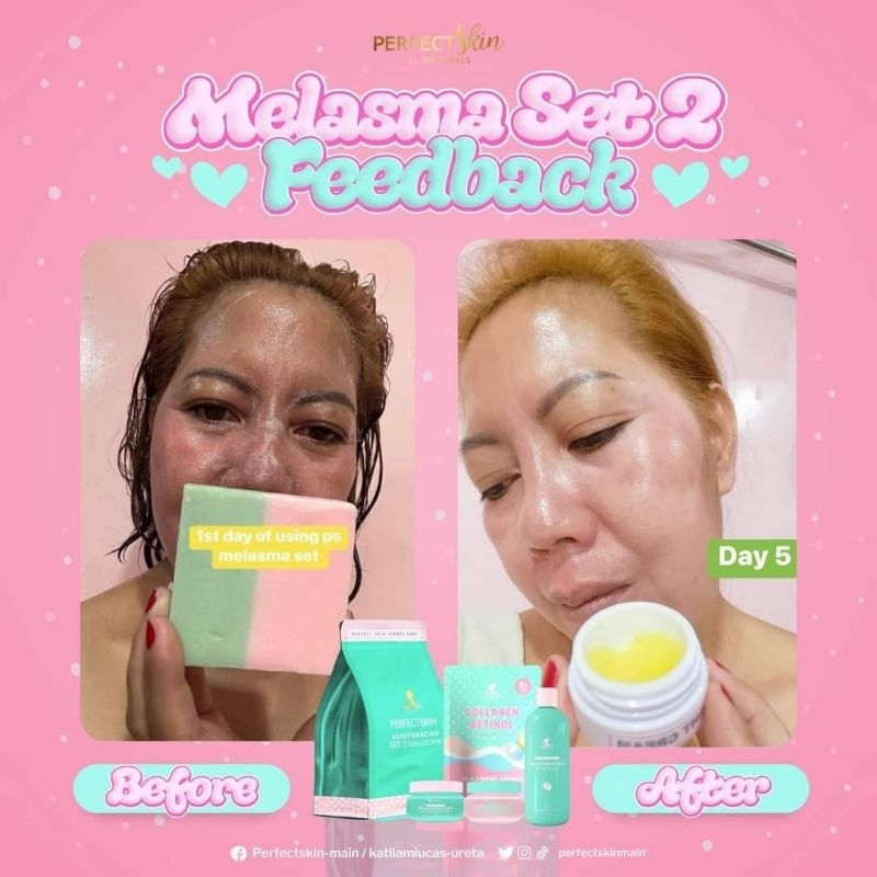 Perfect Skin Melasma Set | Shopee Philippines