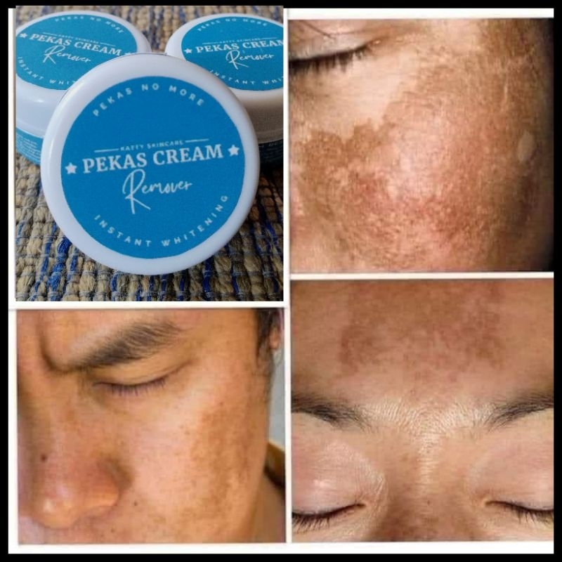 PEKAS NO MORE PEKAS REMOVER (BLUE)CREAM WITH SPF 45 10g | Shopee ...