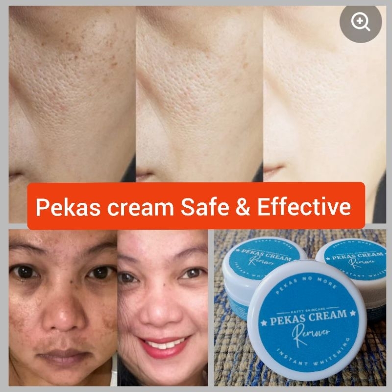 100% ORIGINAL PEKAS NO MORE Pekas (BLUE) Cream Remover with SPF 45 10g ...
