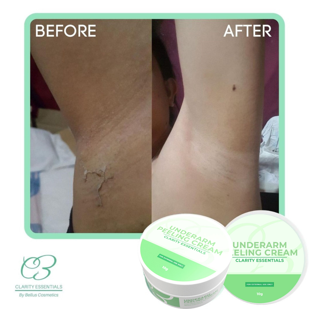 Buy 1 Underarm Peeling Cream Take 1 Underarm Whitening Cream - Clarity ...