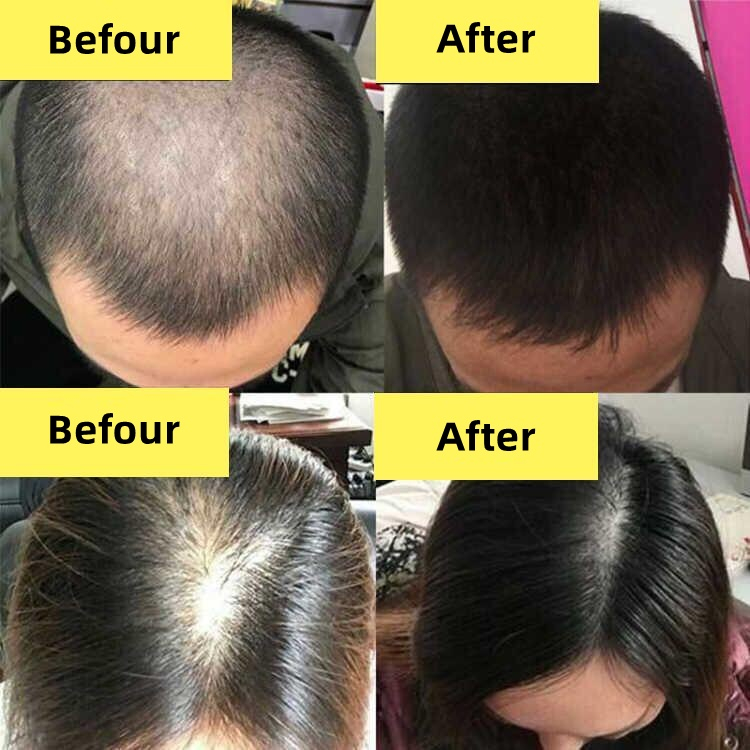 AZLA Ginger Hair Shampoo Fast Regrowth Hair Thick Anti-Hair Loss Anti ...