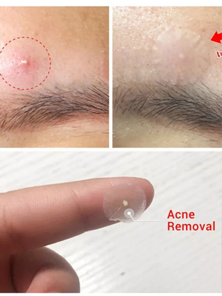 36pcs Lnvisible Acne Pimple Removal Patch Acne Hydrocolloid Stickers ...