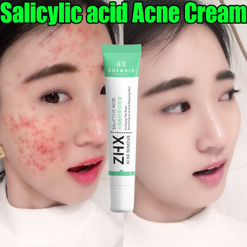 Salicylic acid Pimple remover cream Acne remover Acne Treatment 20g ...