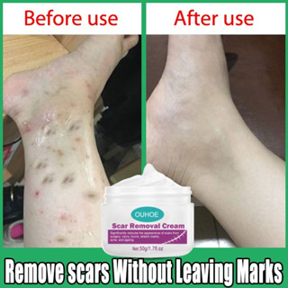 Scar remover cream Removal Mosquito bite scar Keloid scar Old scar ...