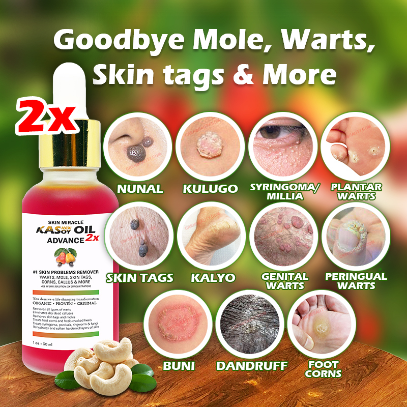 Kasoy Oil 2x Concentration (30ml) #1 Mole remover, Warts, Skin tag ...