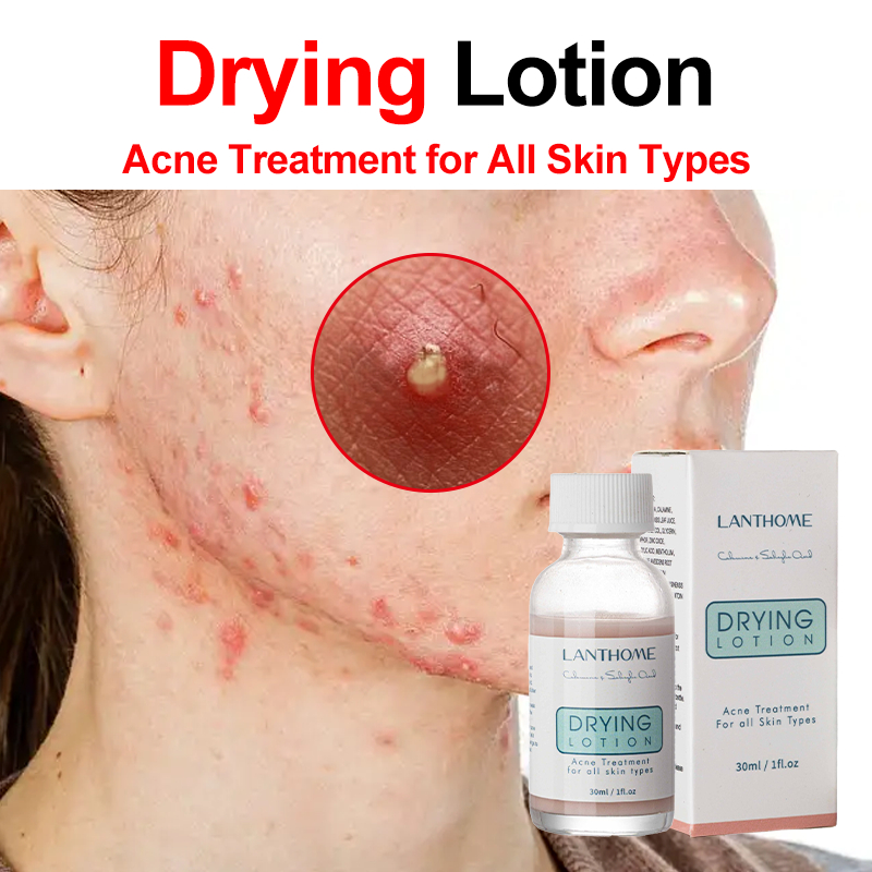 【Effective Acne Removal】Acne Clear Pimple Drying Lotion 30ML Acne ...