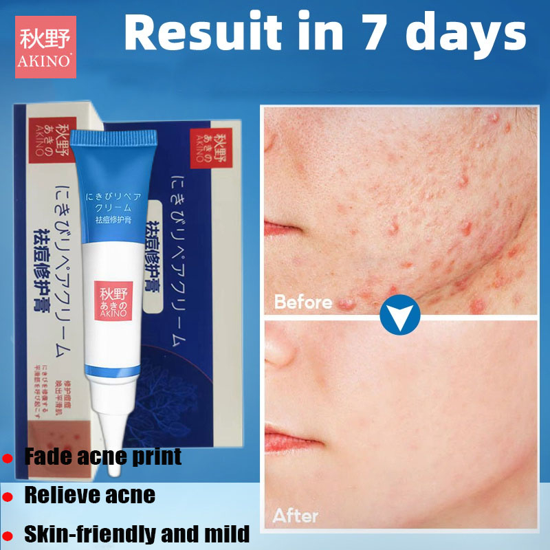 Akino Anti-acne cream acne remover treatment brightening moisturizing ...