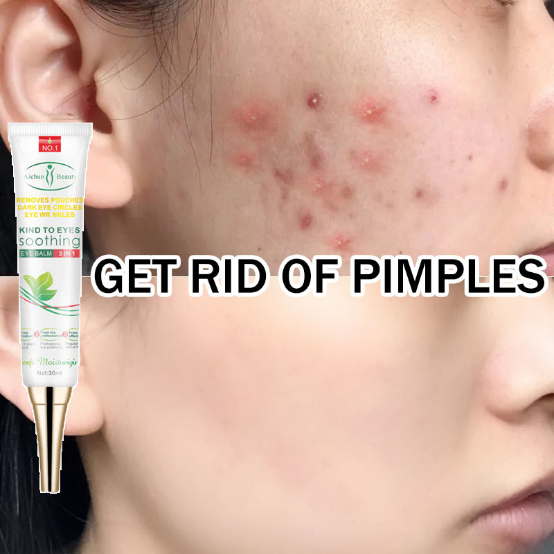 COD Acne Cream Pimple Marks Remover Reduce Acne Acne Care Improve ...
