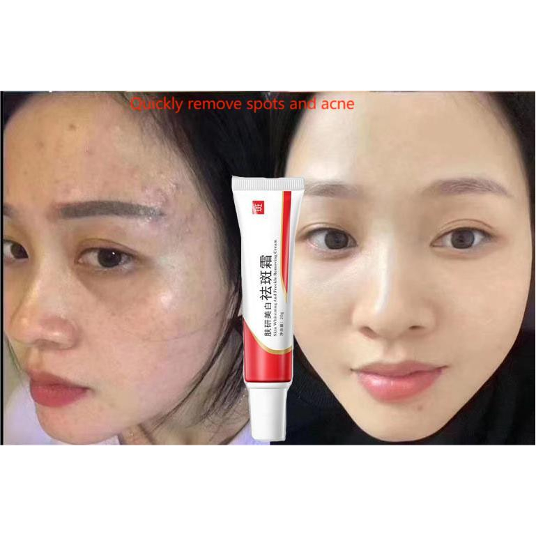 Remover Effective Melasma Cream Anti Freckle Collagen Original Skin ...