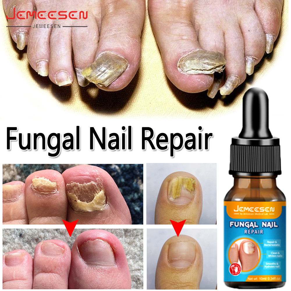 100% Effective Nail Fungus Treatment Nail Repair Essence Anti-fungal ...