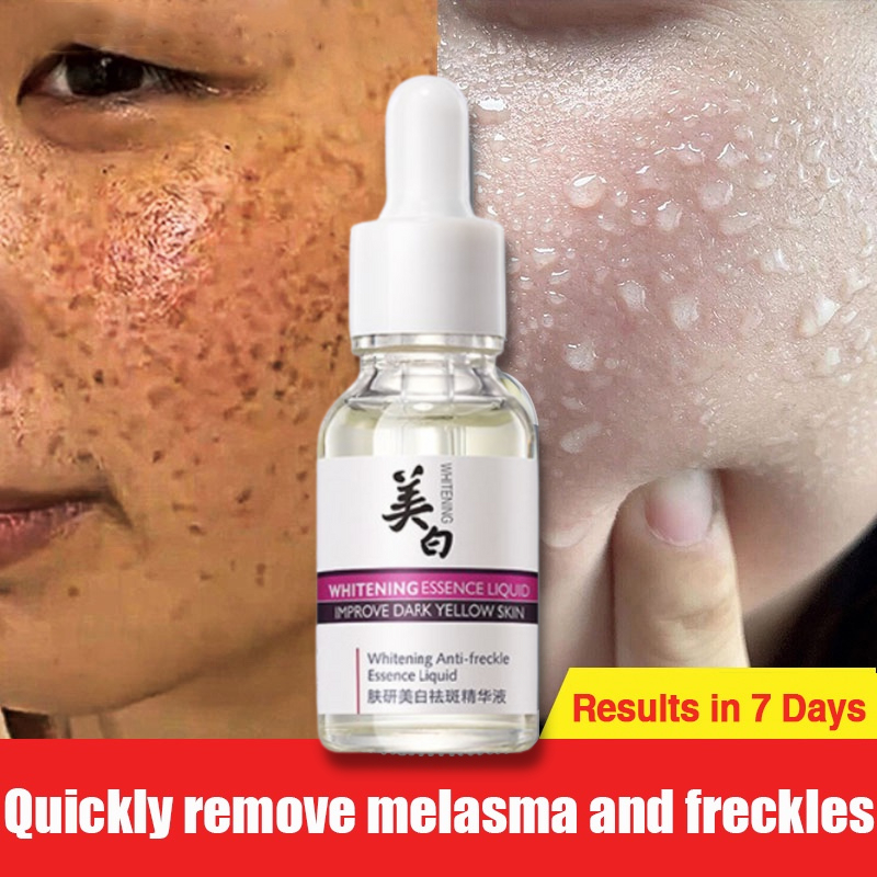 Pekas Remover Serum For Melasma And Dark spot Melasma Serum Pekas ...