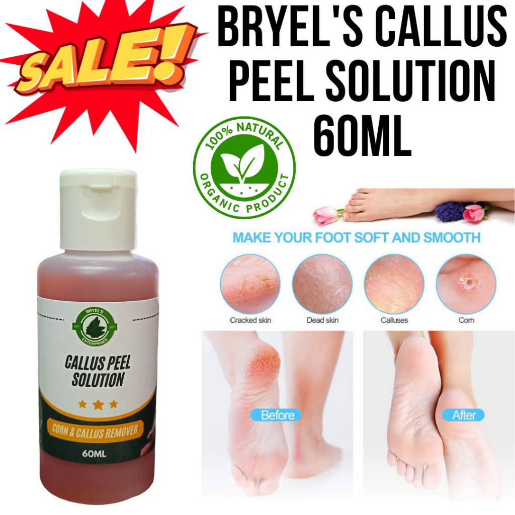 60ml Kalyo Peel/Callus Peel Remover And Callus Pile/Pantanggal Kalyo ...