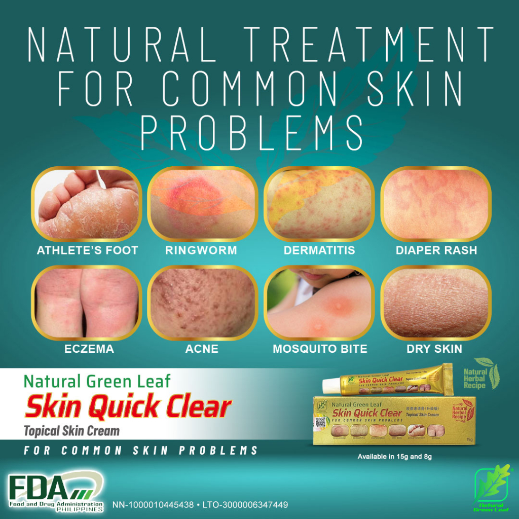 NGL Skin Quick Clear Topical Skin Cream 15g | Shopee Philippines