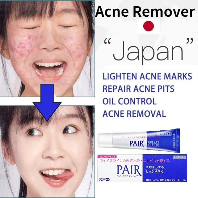 Japan Lion Pair Acne cream pimple remover Treatment Skin cream patch ...