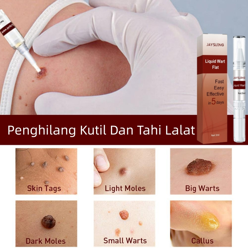 Professional cream for removing warts, moles, deep warts, complete set ...