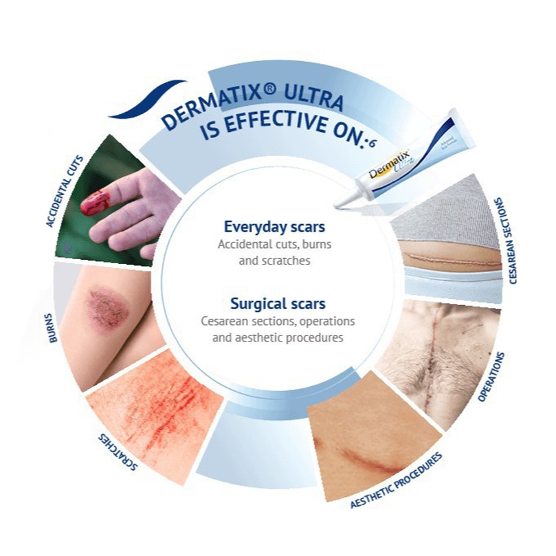 Dermatix Ultra Gel Peklat Remover Cream For Leg Keloid Old Scars ...