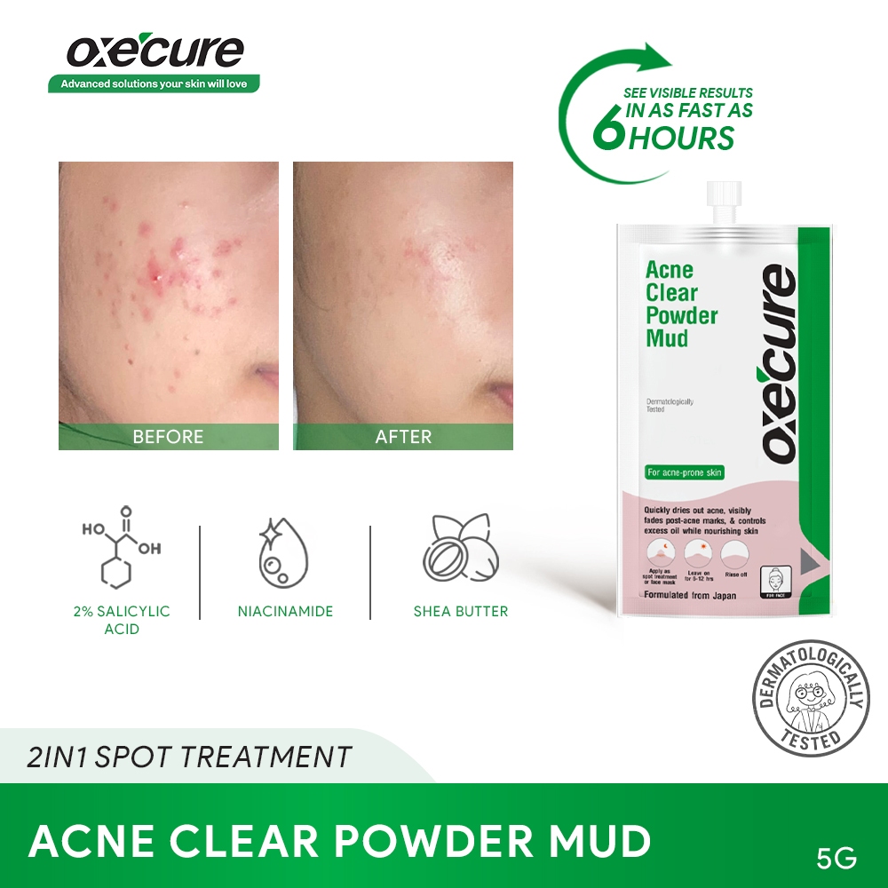 OXECURE Acne Clear Powder Mud 5g | Shopee Philippines